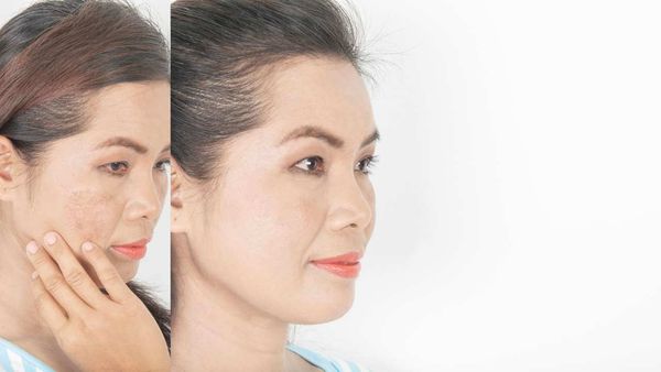 What is Melasma and How Can You Beat It Once and For All?